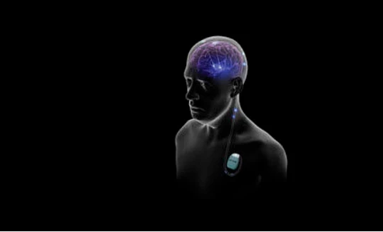 Deep Brain Stimulation (DBS) Part 4: My Journey to an Electric Brain ...